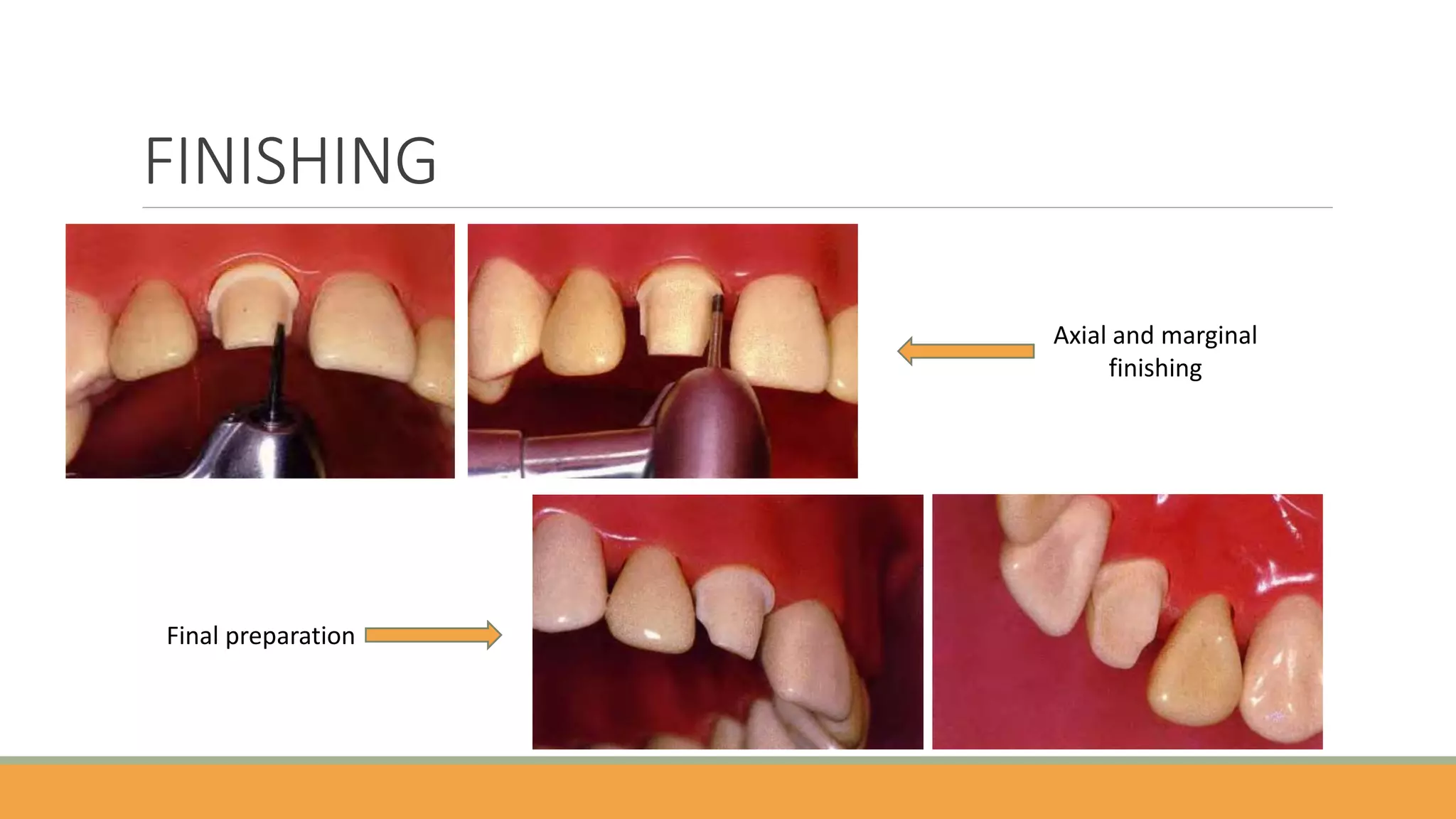 TOOTH PREPARATION: FULL VENEER ANTERIOR PFM | PPTX