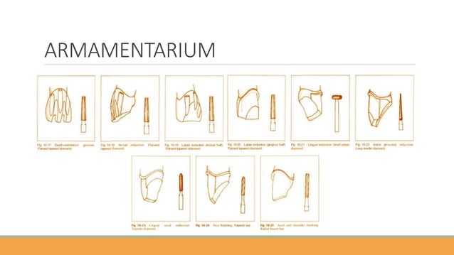 TOOTH PREPARATION: FULL VENEER ANTERIOR PFM | PPTX