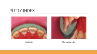 TOOTH PREPARATION: FULL VENEER ANTERIOR PFM | PPTX