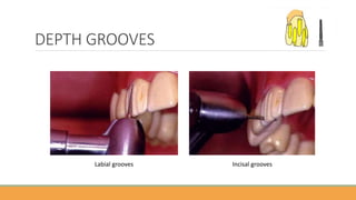 TOOTH PREPARATION: FULL VENEER ANTERIOR PFM | PPTX