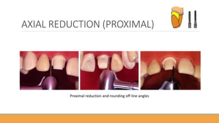 TOOTH PREPARATION: FULL VENEER ANTERIOR PFM | PPTX