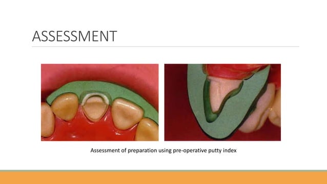 TOOTH PREPARATION: FULL VENEER ANTERIOR PFM | PPTX