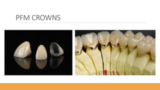 TOOTH PREPARATION: FULL VENEER ANTERIOR PFM | PPTX