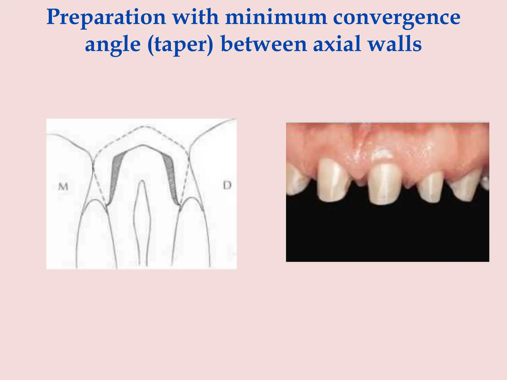PRINCIPLES OF TOOTH PREPARATION ppt given | PPTX