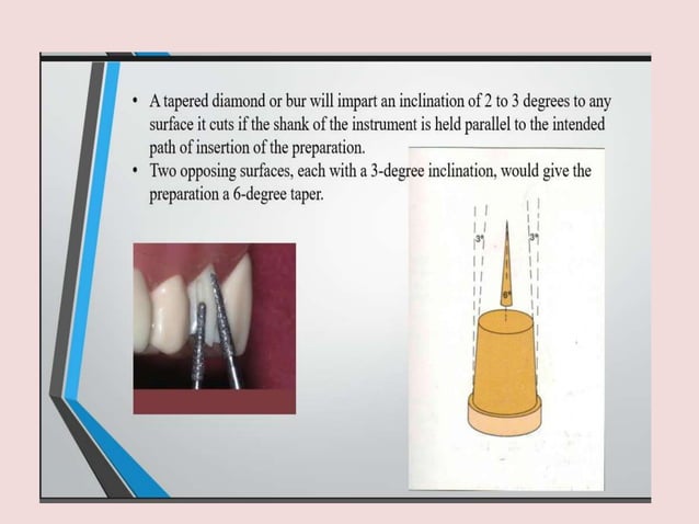 PRINCIPLES OF TOOTH PREPARATION ppt given | PPTX