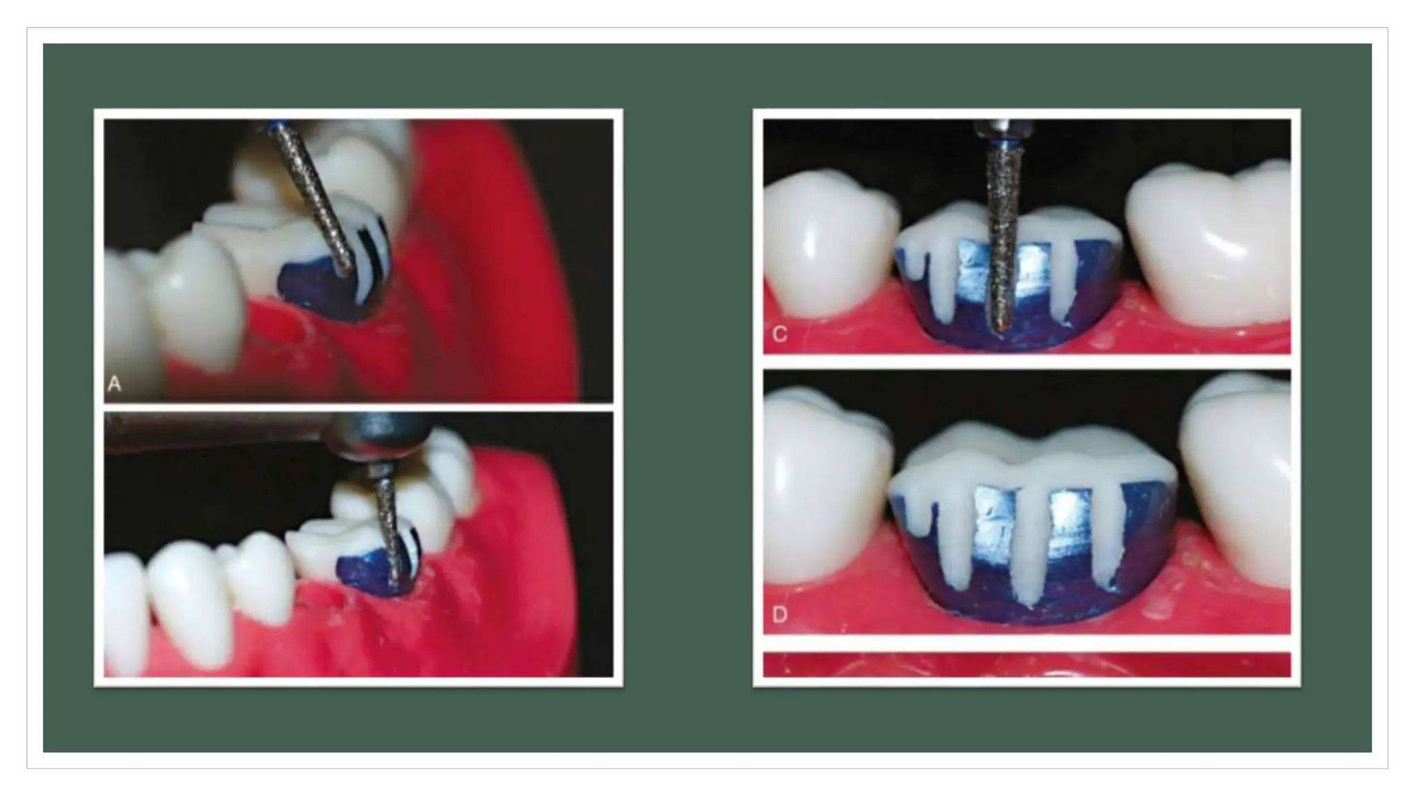 TOOTH Preparation for posterior tooth.pptx
