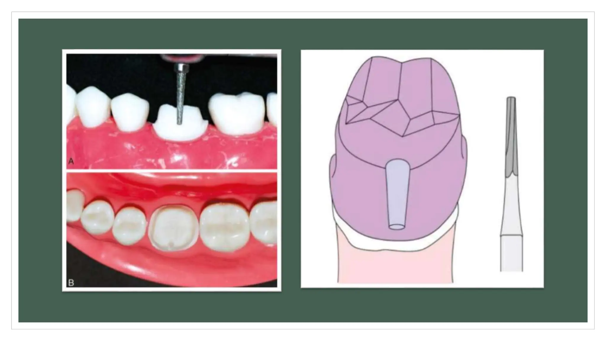 TOOTH Preparation for posterior tooth.pptx