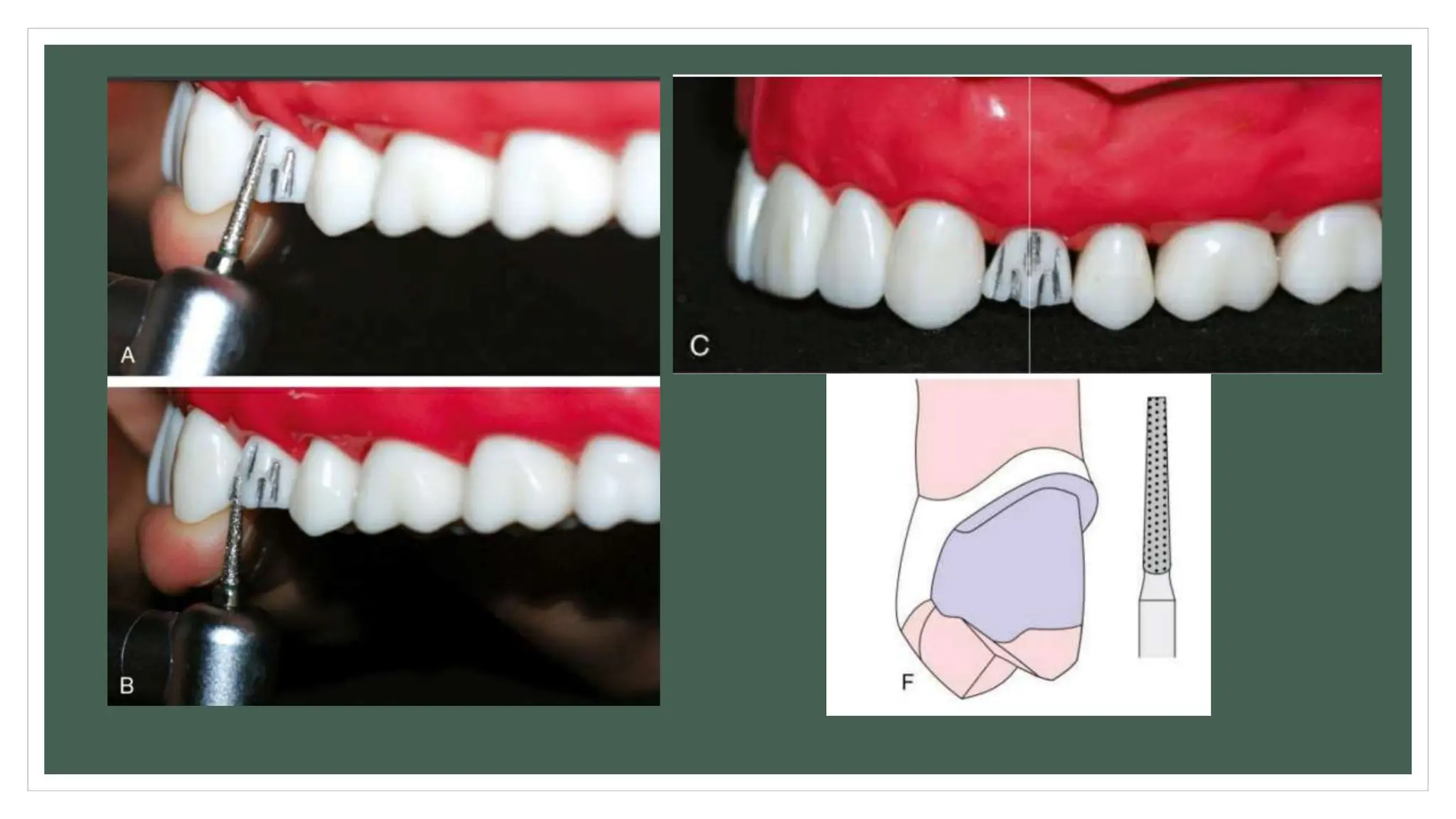 TOOTH Preparation for posterior tooth.pptx