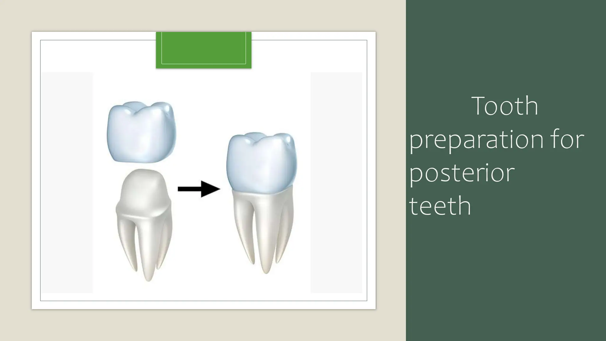 TOOTH Preparation for posterior tooth.pptx