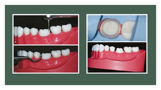 TOOTH Preparation for posterior tooth.pptx