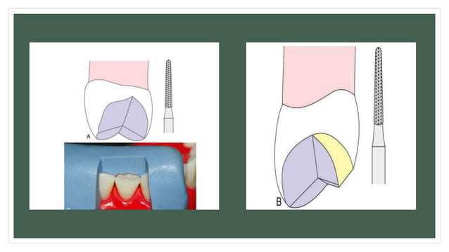 TOOTH Preparation for posterior tooth.pptx