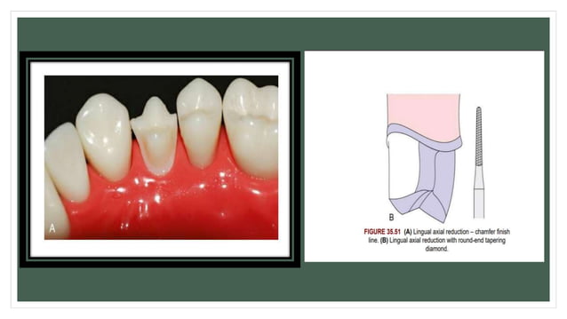 TOOTH Preparation for posterior tooth.pptx