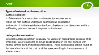 Tooth resorption | PPTX