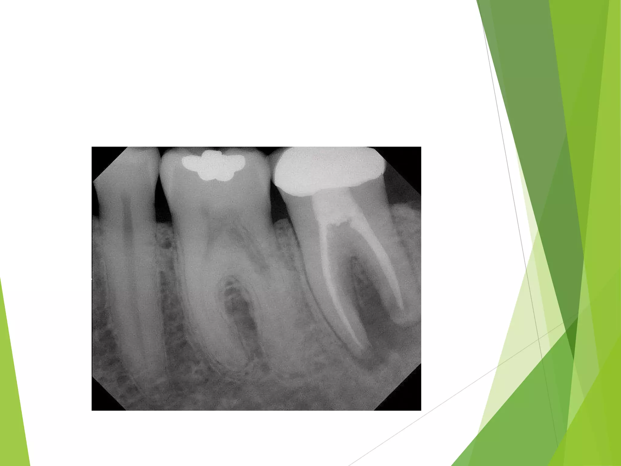 Tooth resorption | PPTX