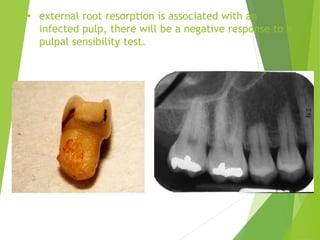 Tooth resorption | PPTX