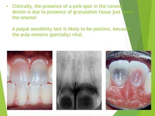 Tooth resorption | PPTX