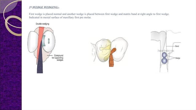 TOOTH SEPARATION DURING DENTAL RESTORATION.pptx