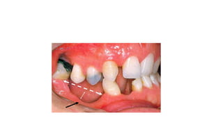tooth set up 2.pptx
