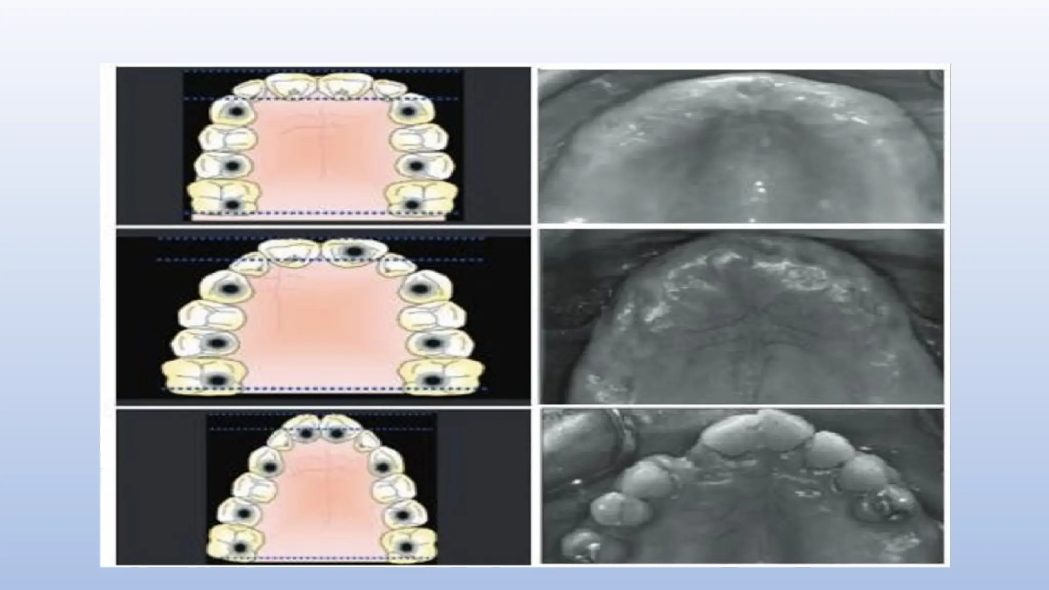 Arrangement of posterior teeth in edentulous patients.tooth set up .pptx