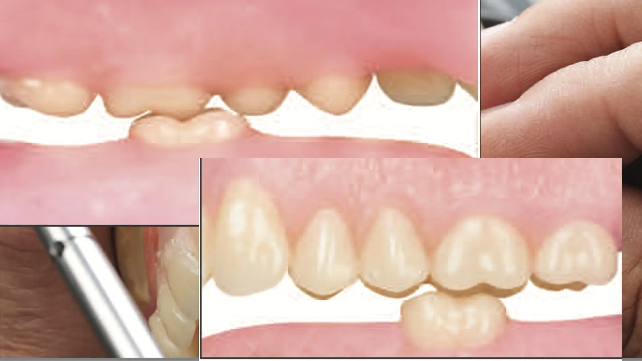 Arrangement of posterior teeth in edentulous patients.tooth set up .pptx
