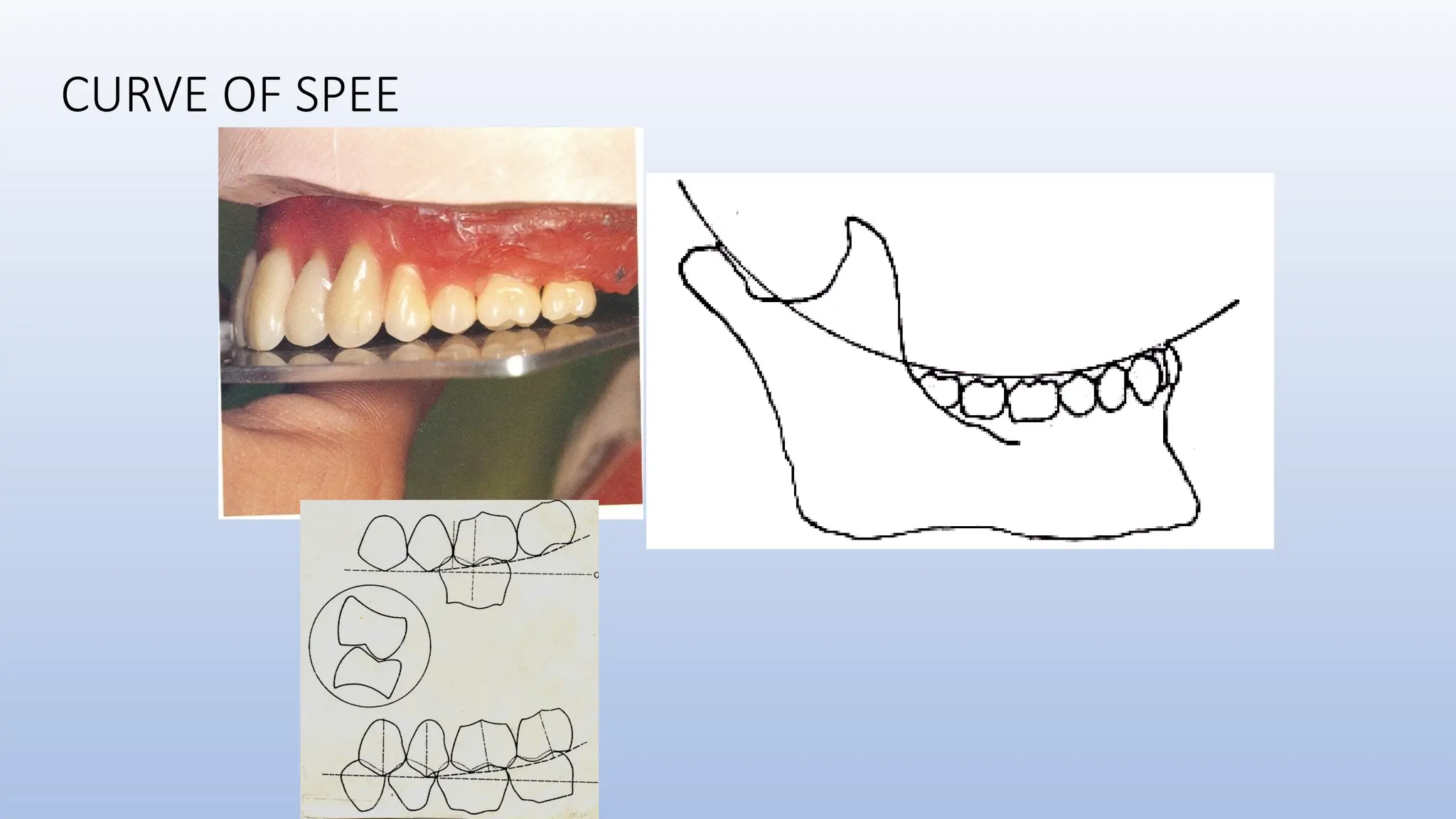 Arrangement of posterior teeth in edentulous patients.tooth set up .pptx