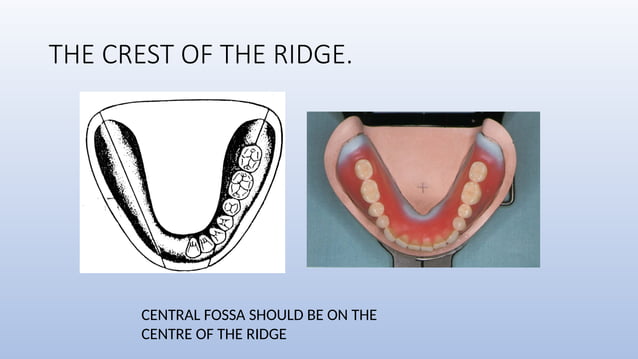 Arrangement of posterior teeth in edentulous patients.tooth set up .pptx