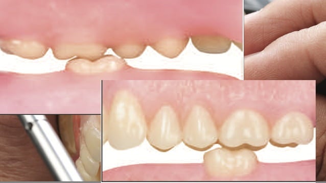 Arrangement of posterior teeth in edentulous patients.tooth set up .pptx
