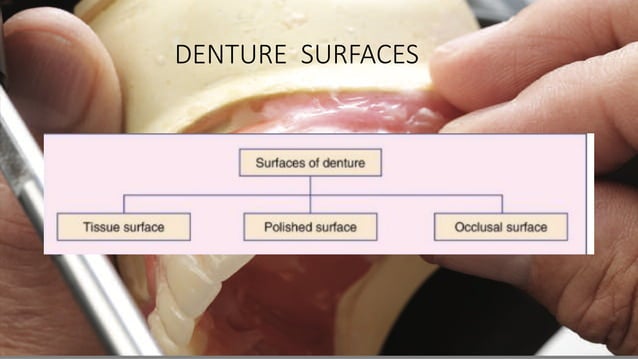 Arrangement of posterior teeth in edentulous patients.tooth set up .pptx