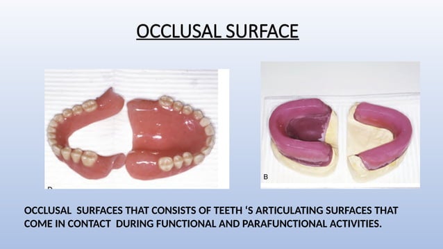 Arrangement of posterior teeth in edentulous patients.tooth set up .pptx
