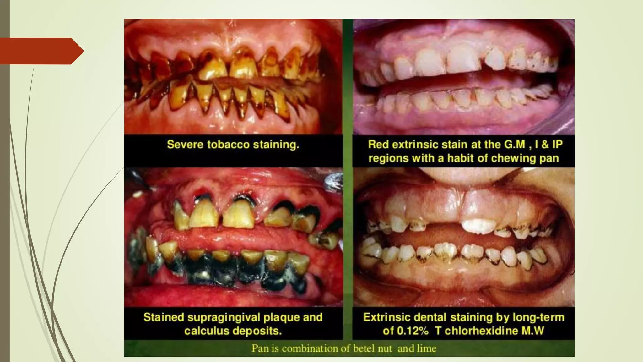 Tooth Staining and Discoloration | PPTX