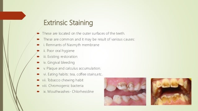 Tooth Staining and Discoloration