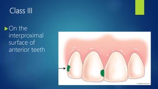 Tooth Structures, Periodontium, and Caries Classifications Powerpoint ...