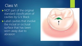 Tooth Structures, Periodontium, and Caries Classifications Powerpoint ...