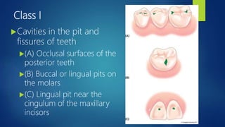 Tooth Structures, Periodontium, and Caries Classifications Powerpoint | PPT