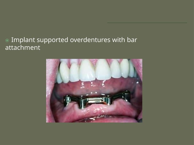 toothsupportedoverdentures in prosthodontics | PPT