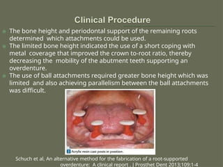 toothsupportedoverdentures in prosthodontics | PPT