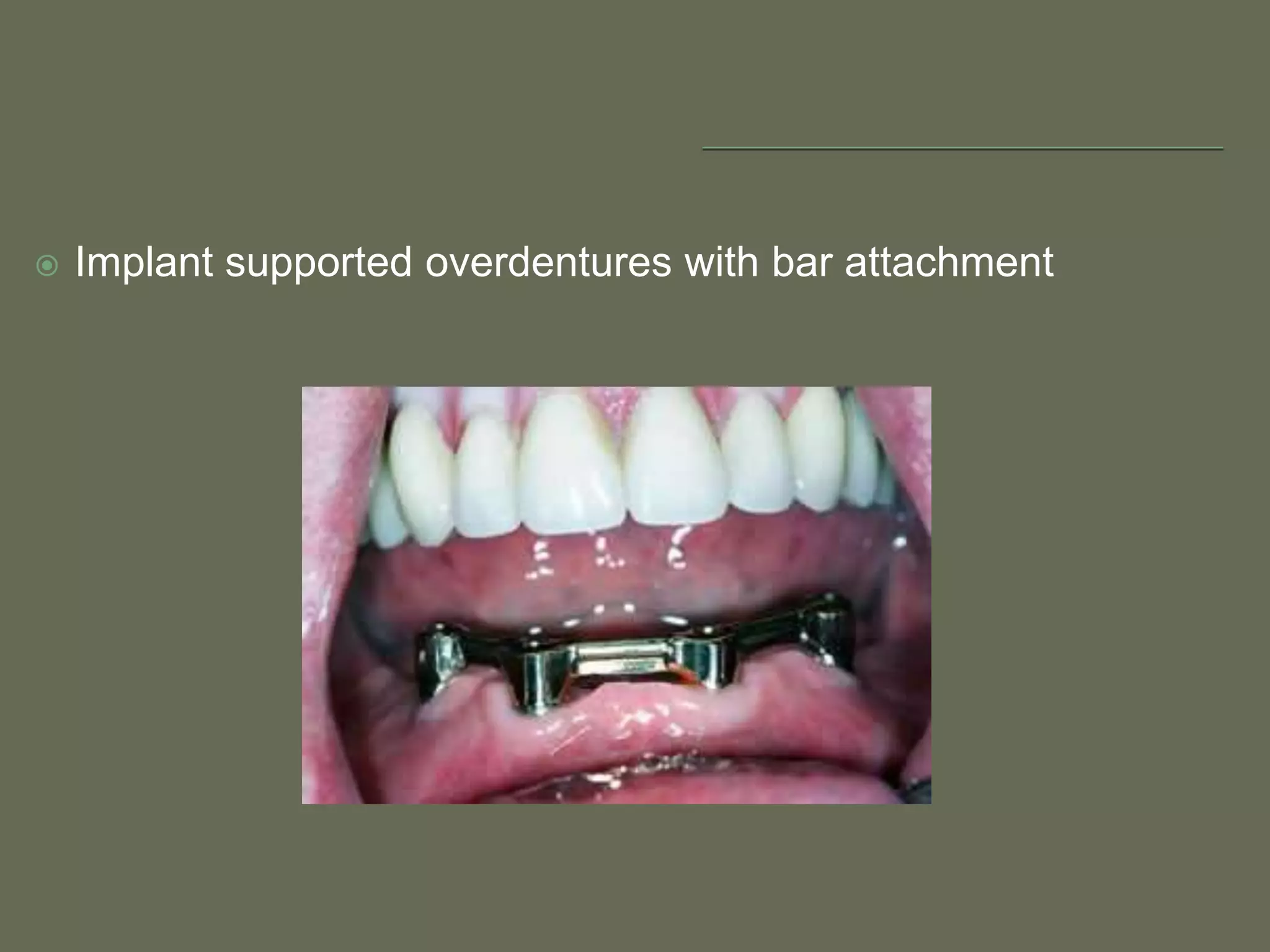 Tooth supported overdentures- Journal Club | PPT