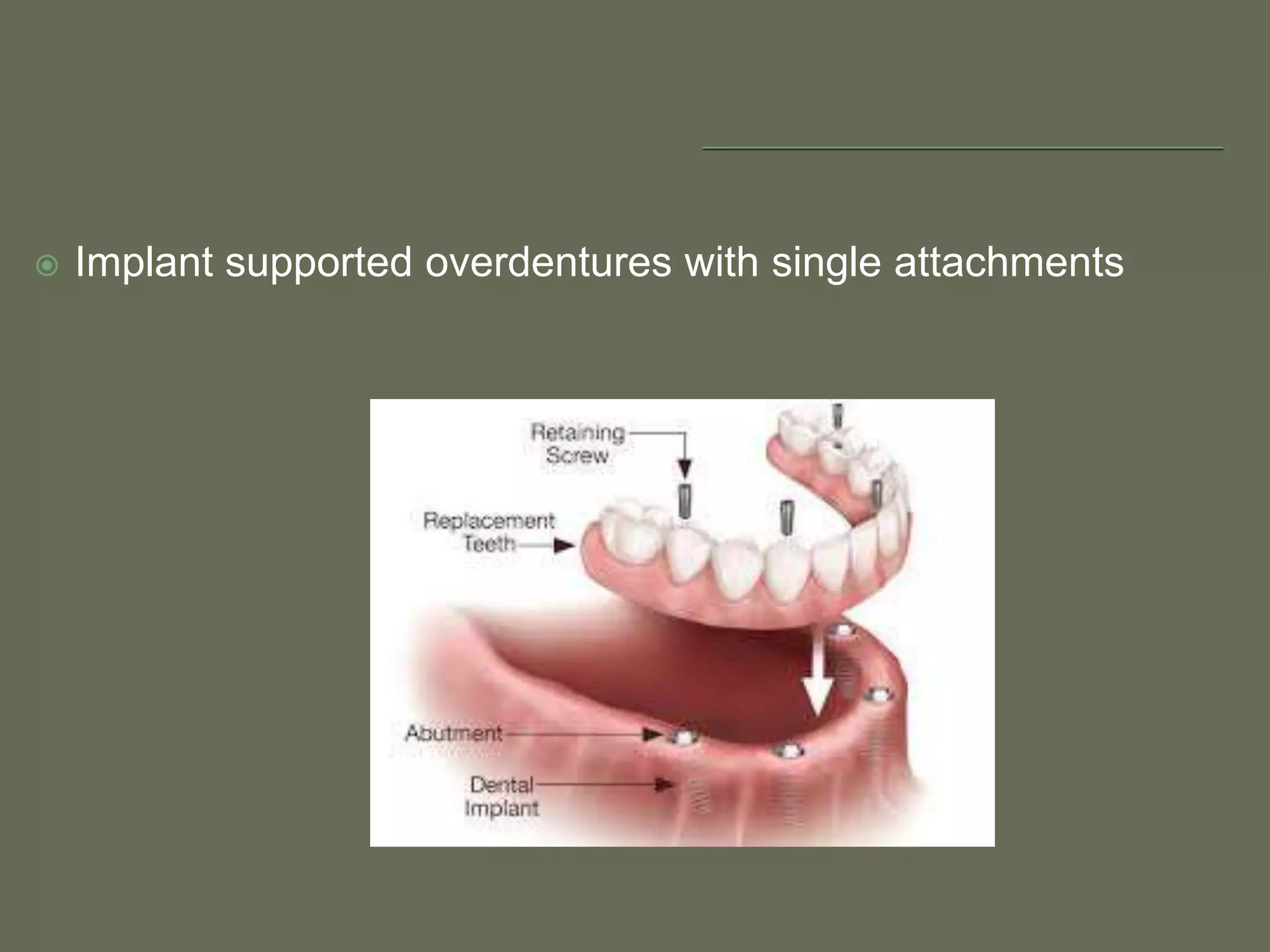Tooth supported overdentures- Journal Club | PPT