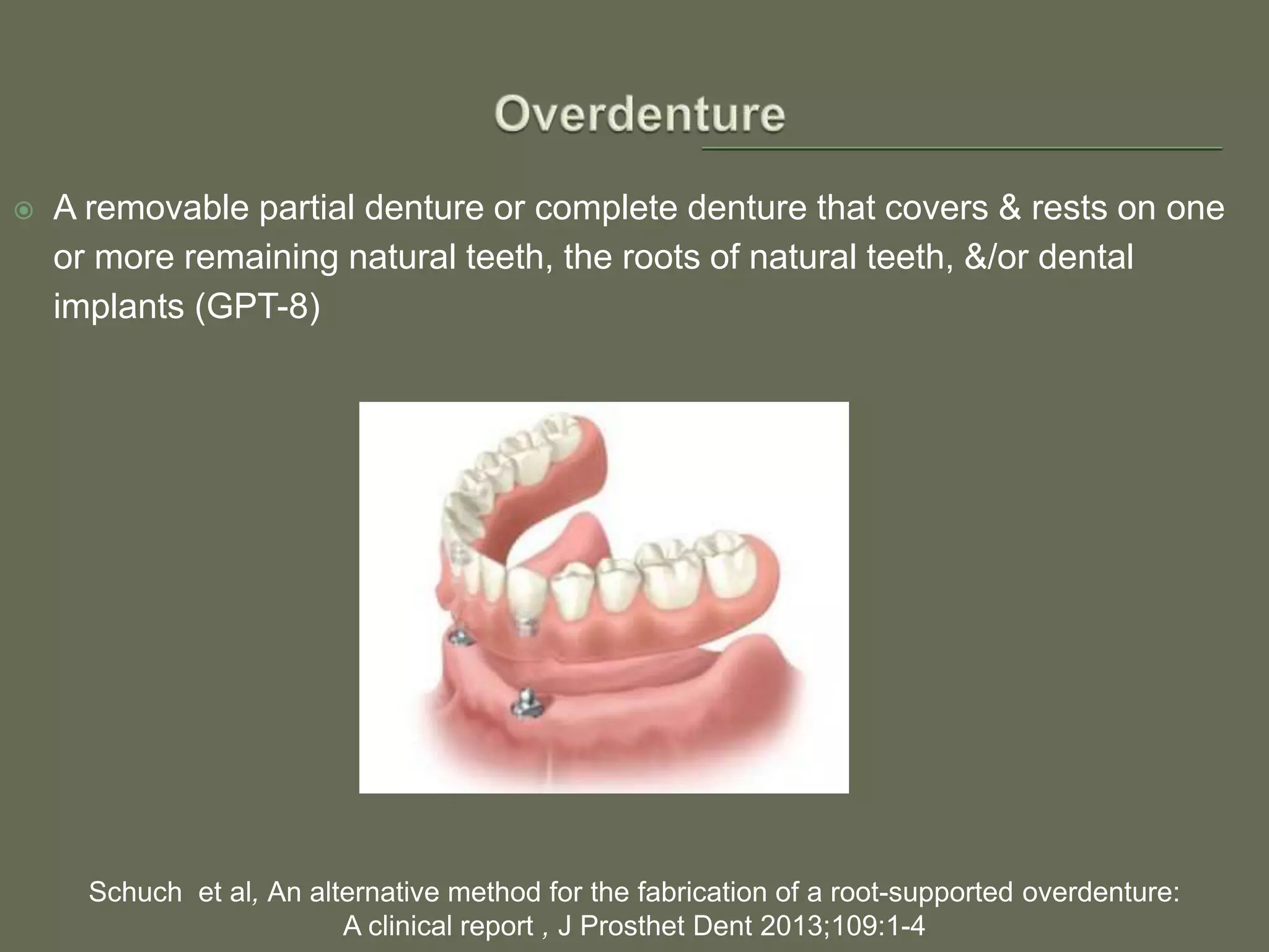 Tooth supported overdentures- Journal Club | PPT