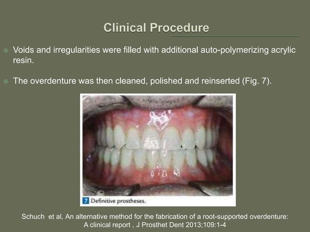 Tooth supported overdentures- Journal Club | PPT