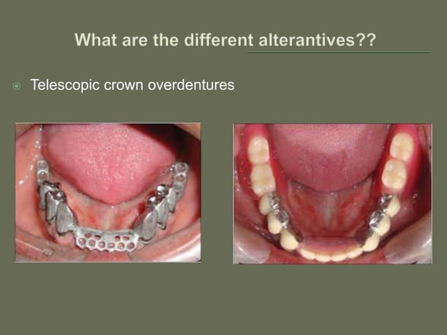 Tooth supported overdentures- Journal Club | PPT