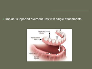 Tooth supported overdentures- Journal Club | PPTX