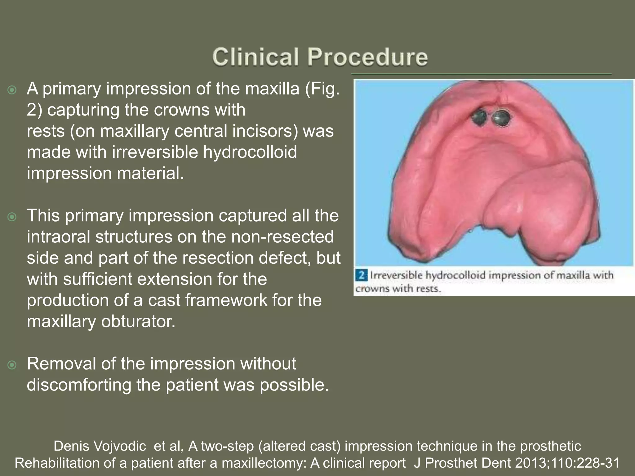 Altered Cast Impression Technique for Fabrication of Maxillary ...
