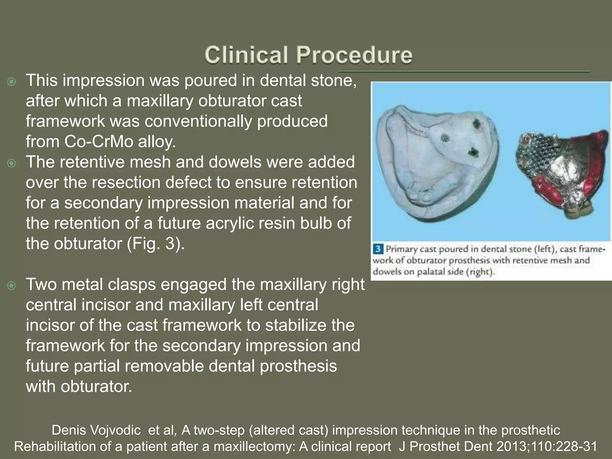Altered Cast Impression Technique for Fabrication of Maxillary ...