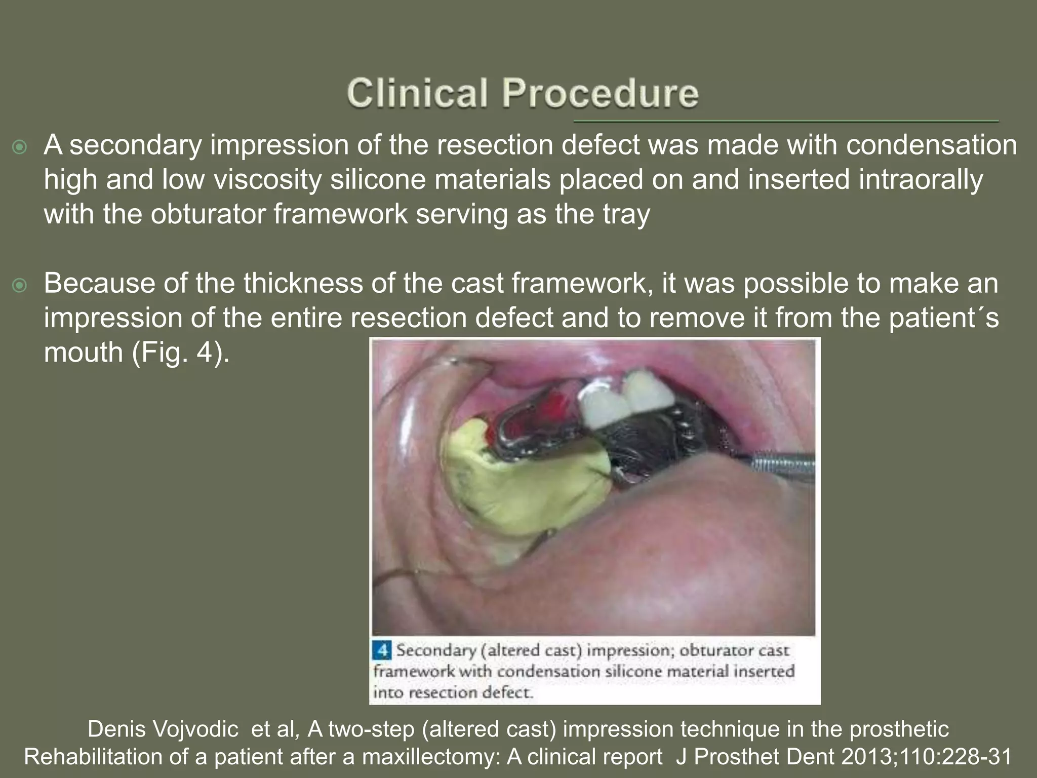 Altered Cast Impression Technique for Fabrication of Maxillary ...