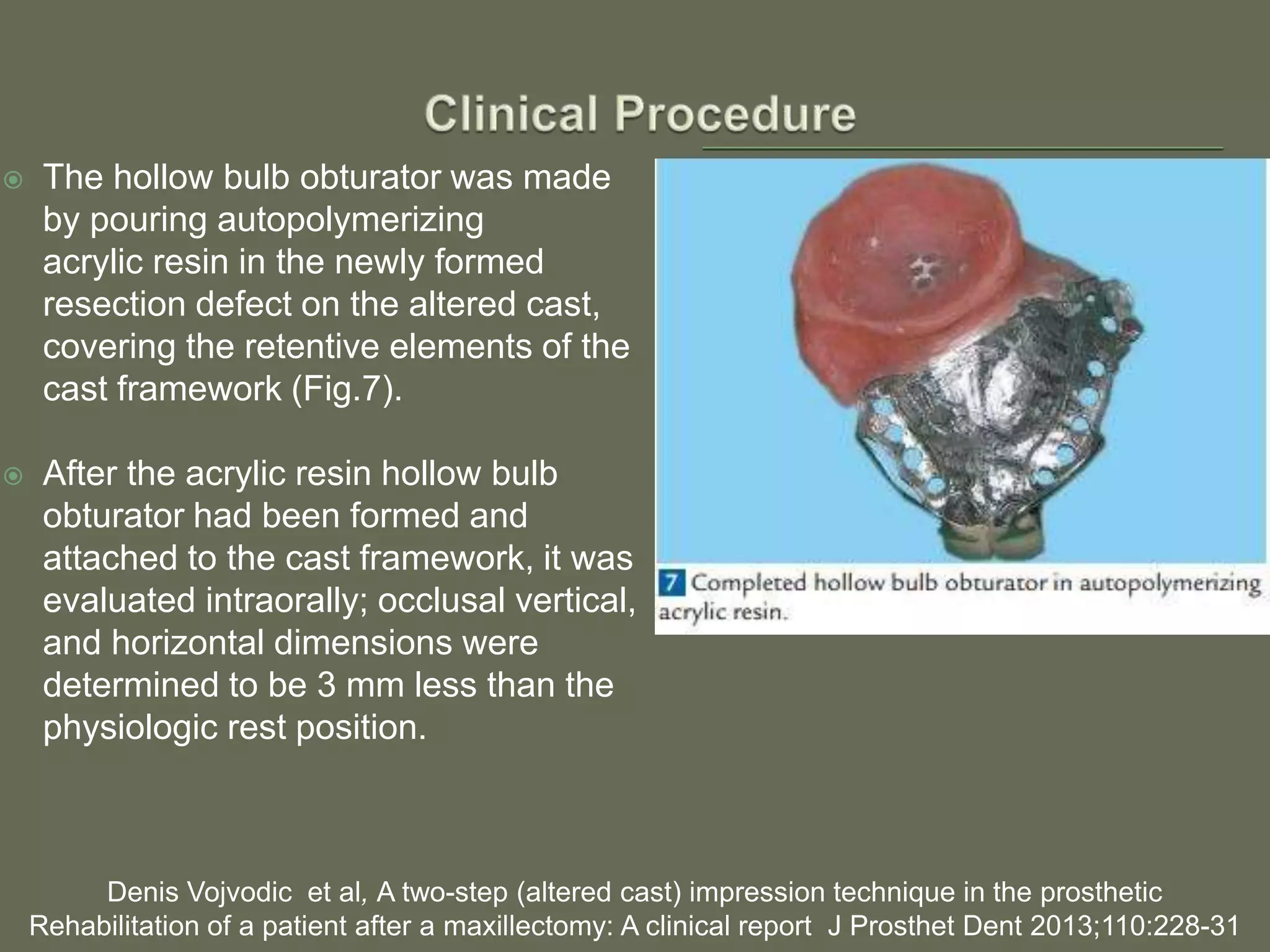 Altered Cast Impression Technique for Fabrication of Maxillary ...