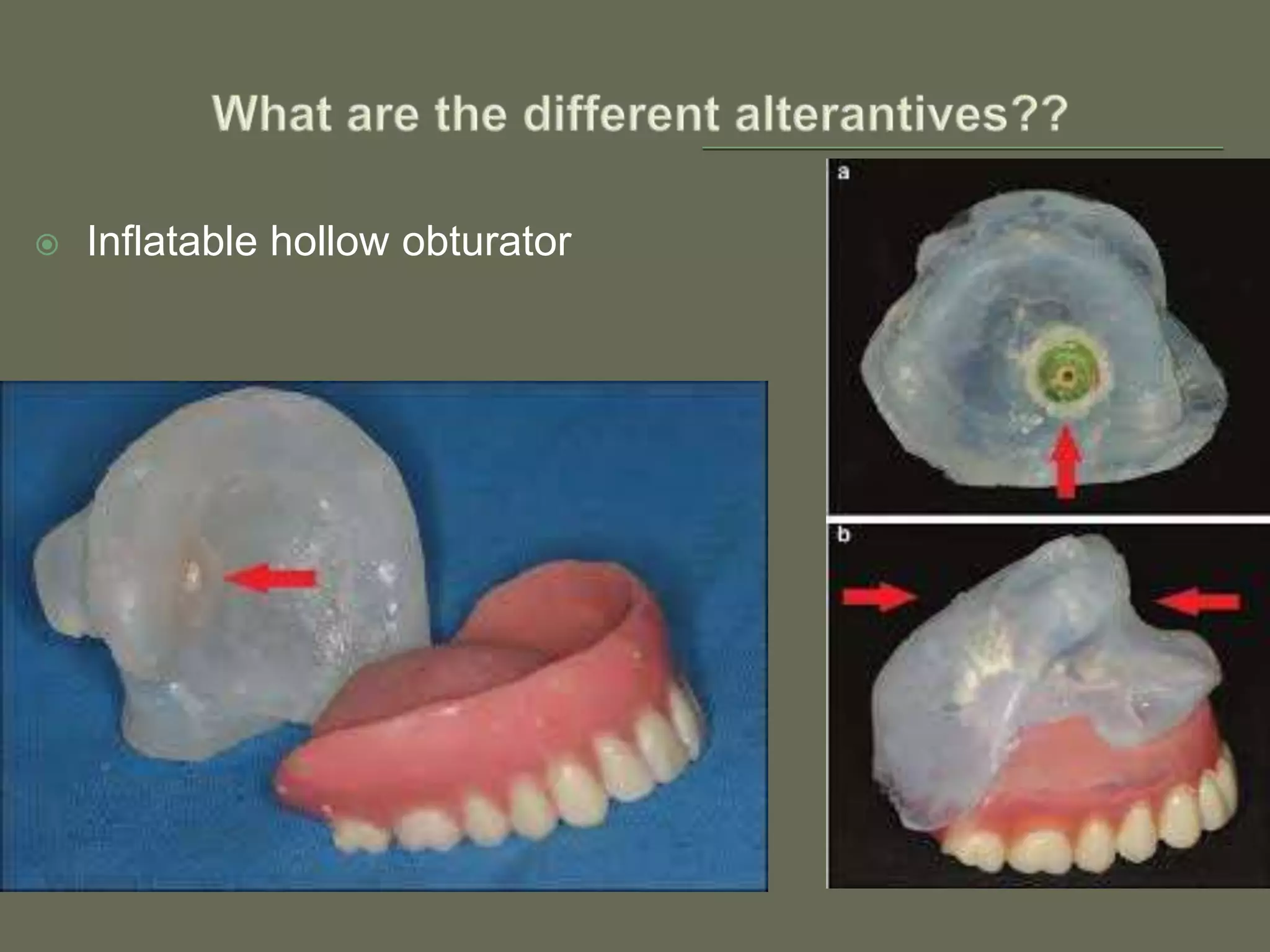Altered Cast Impression Technique for Fabrication of Maxillary ...