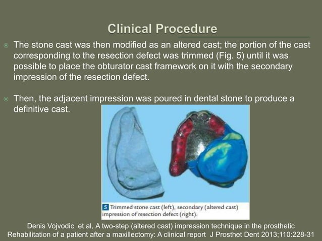 Altered Cast Impression Technique for Fabrication of Maxillary ...