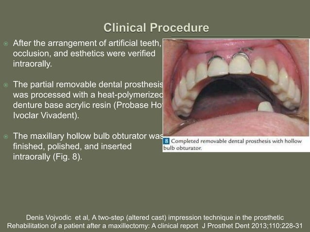 Altered Cast Impression Technique for Fabrication of Maxillary ...