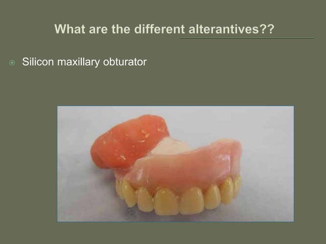 Altered Cast Impression Technique for Fabrication of Maxillary ...
